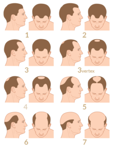 Traitement de l'alopécie : lutter contre la chute des cheveux - Docteur ...